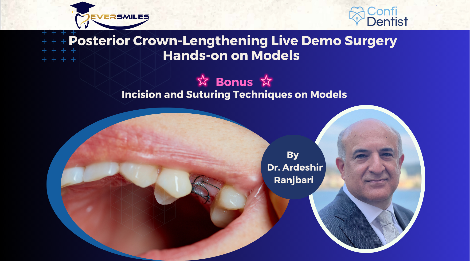 Posterior Crown-Lengthening - Eversmiles